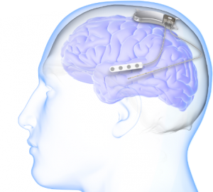 NeuroPace RNS System |For Providers